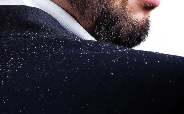 Tipos de caspa, ¿por qué salen? | Belleza